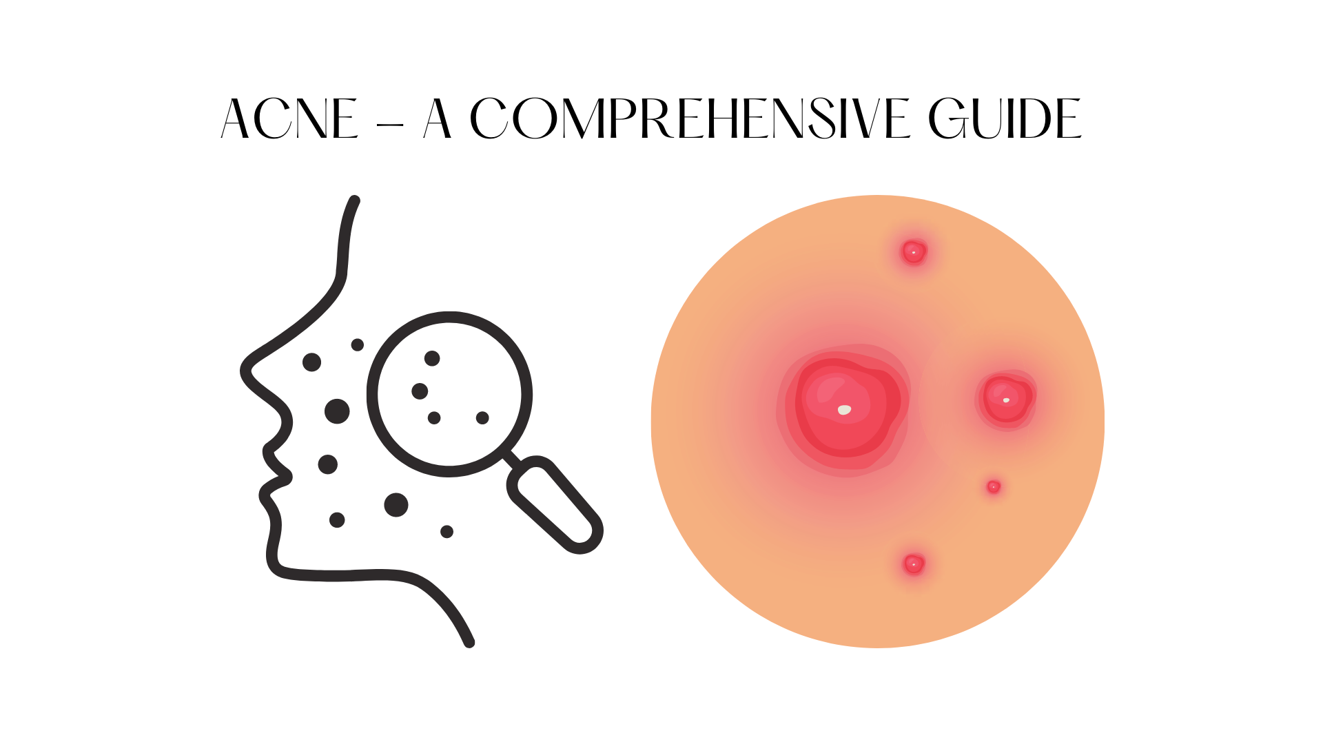 Acne - A Comprehensive Guide